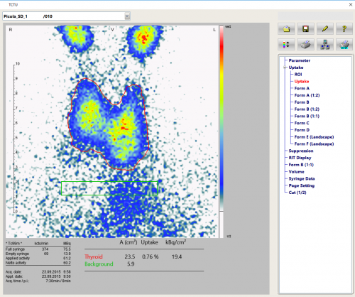 Thyroid Scintigraphy And Uptake Calculation Mie 6391